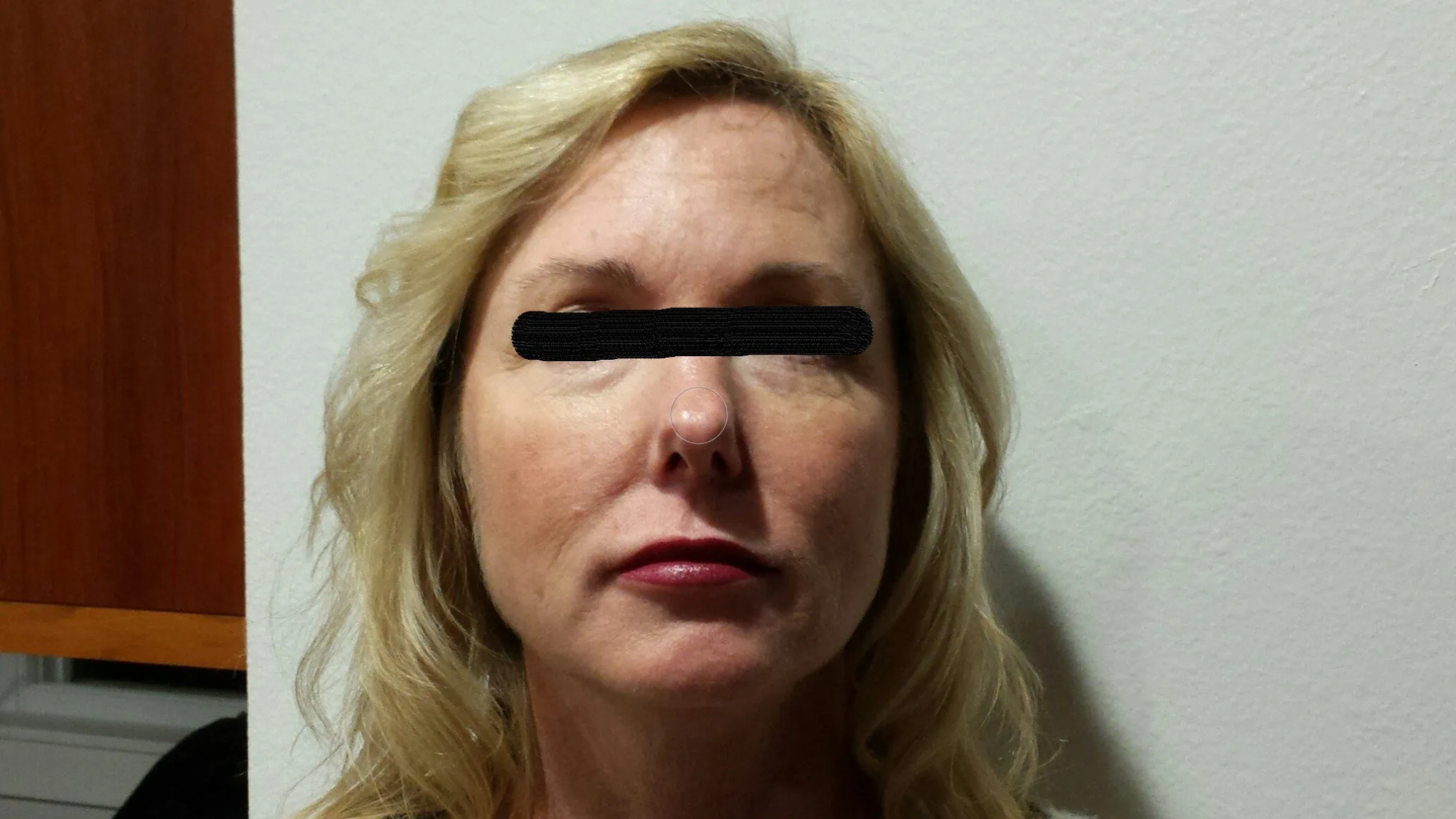 Pre and Post Surgery - 123 HBOT